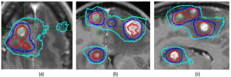 Comparison Of Monte Carlo Dose Contours Based On The True Ct And Sct