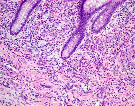 Goblet Cell Adenocarcinoma Of The Appendix Diagnosis Prognosis And