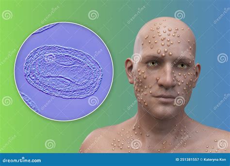 A Man With Smallpox Disease And Close Up View Of Variola Virus A Virus From Orthopoxviridae
