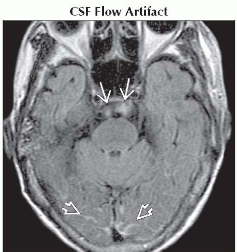 Prepontine Cistern Mass Neupsy Key