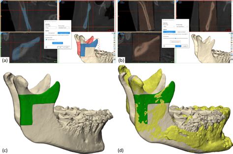 Surface And Voxel Based Registration On The Right Ramus Voxel Based