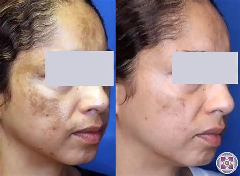 Melasma Laser Treatment Ama Regen Med And Skincare