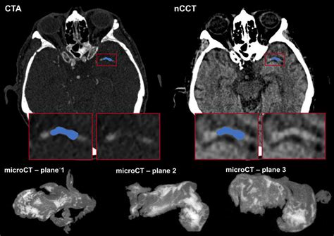 Ct Imaging And Segmentation Cta And Ncct Images Were Registered In A
