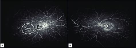 Ultrawide Field Fluorescein Angiogram Of The Patient Showing A Cnvm Download Scientific