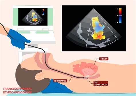 Transesophageal Echocardiogram