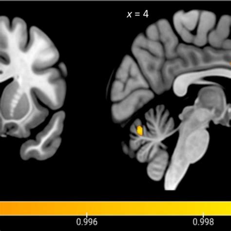 Voxel Based Morphometry Analyses Showing Regions Of Significant Grey Download Scientific