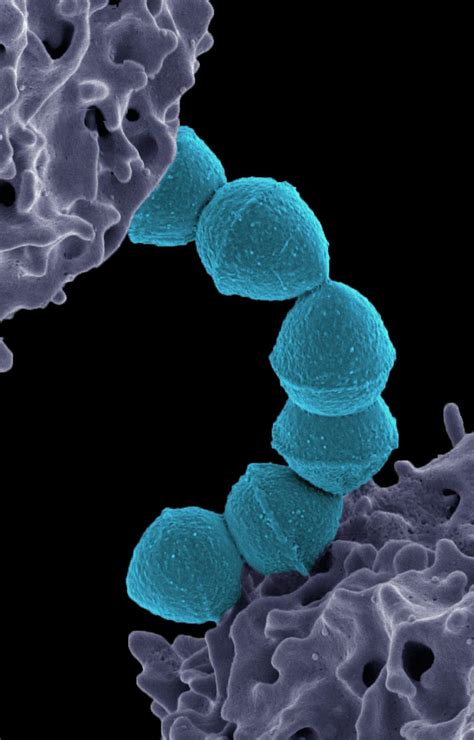 Strep A Explainer Why Invasive Cases Are Increasing How It Spreads And What Symptoms To Look For