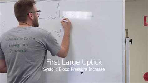 Arterial Line Waveform Interpretation And Safe Transport Youtube
