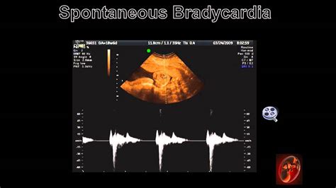 Fetal Echocardiograph Common Fetal Arrhythmias Youtube