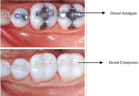 Dental Composites Structure At Joyce Sargent Blog