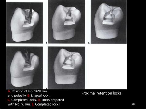 Class Ii Amalgam Pptx