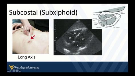 Cardiopulmonary Pocus 4 The Apical 4 Chamber Cardiac View Youtube