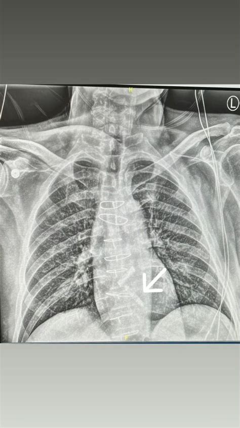 Dr Mansi Patel On Linkedin I Recently Experienced The Avier Leadless