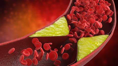 High Cholesterol Can Be Inherited All You Need To Know About Familial