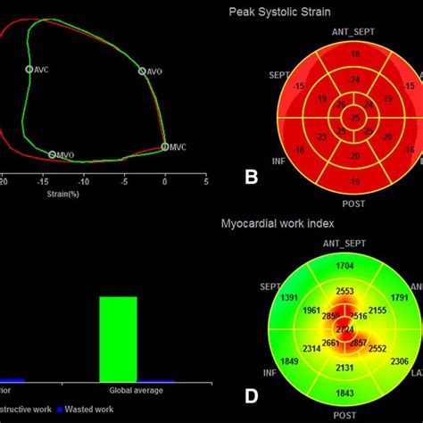 A And C 17 Segment Bulls Eye Representation Of Mw Index And Myocardial Download Scientific
