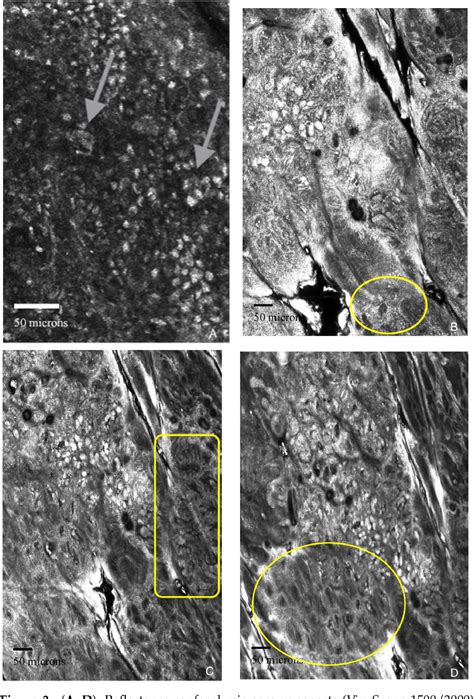 Figure 1 From The Importance Of In Vivo Reflectance Confocal Microscopy In A Case Of