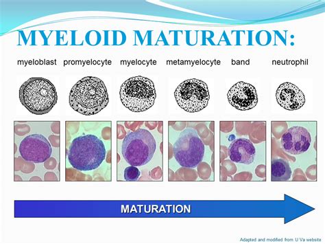 Leukemia Epidemiologi Patogenesis Leukemia Akut
