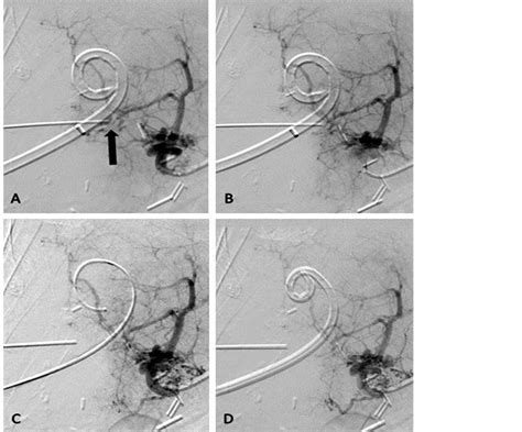 Percutaneous Embolization Of A Hepatic Artery Pseudoaneurysm Under