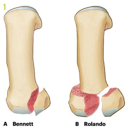 Rolando Fracture Wikism Sports Medicine Wiki