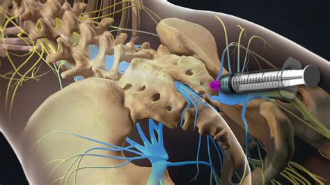 Lumbar Caudal Epidural Steroid Injection Southlake Texas South Lake