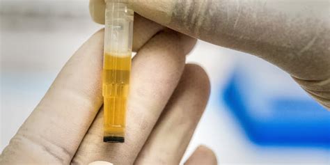 Leucocitos en la orina qué significa Blog SaludOnNet