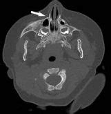Pyriform Aperture Stenosis Symptoms Causes Genetics Surgery
