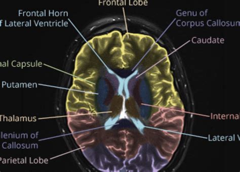 Cross Sectional Anatomy Mri Brain Sagittal Anatomy
