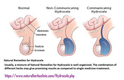 Hidrocele Tratamiento Foto Gratis En Pixabay Pixabay