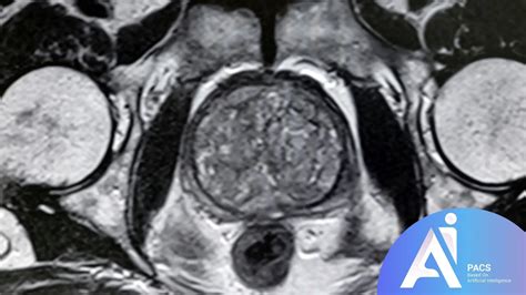 Understanding Prostate Mri Report A Step By Step Guide Ai Pacs