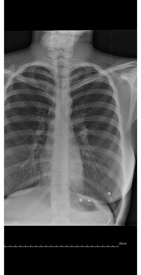 Best R Xrays Images On Pholder This Looks Bent Displaced To Me Dr Says Its Fine