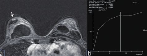 Case 4 Same Patient Than Figure 4 Dynamic Contrast Enhanced Breast Download Scientific