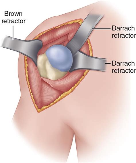 Total Shoulder Arthroplasty Clinical Tree