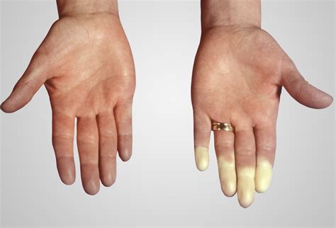Raynaud Phenomenon Revisiting A Cold Weather Problem Rheumatology Advisor