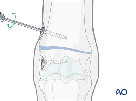 Growth Retardation For Angular Limb Deformities