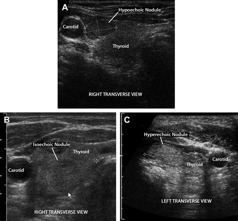 Clinician Performed Thyroid Ultrasound Otolaryngologic Clinics Of North America Clinician Performed Thyroid Ultrasound Otolaryngologic Clinics Of North America