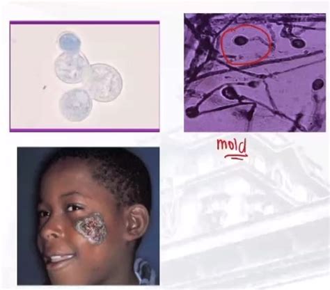 Systemic Mycoses Primary Mycoses Flashcards Quizlet