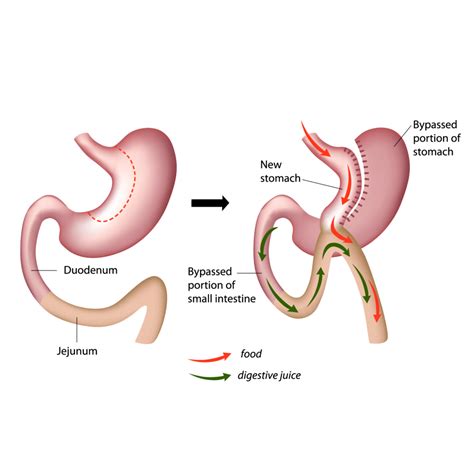 Mini Gastric Bypass Surgery Safe Booking Surgery