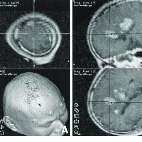 Neuronavigation System Images Demonstrating Before A And After B Download Scientific