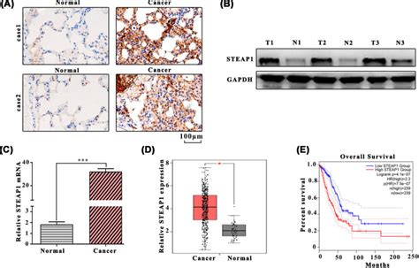 Steap1 Facilitates Metastasis And Epithelial Mesenchymal Transition Of Lung Adenocarcinoma Via