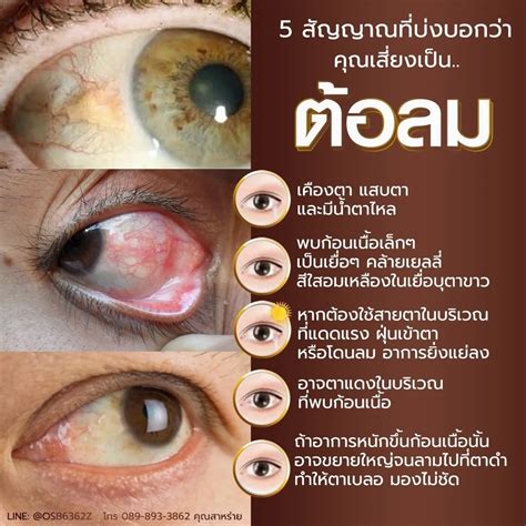 ต้อลม แสบคันเคืองตา น้ำตาไหล อย่ารอ แกลเลอรีที่โพสต์โดย ศูนย์สุขภาพดี Lemon8