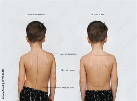 Stockfoto Signs Of Scoliosis Normal Healthy Spine And Curved Spine