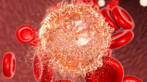 Descubre Los Diferentes Tipos De Leucemia Síntomas Causas Y