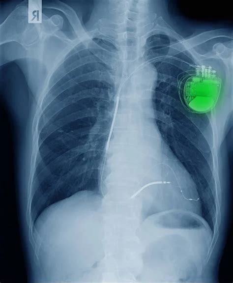 Chest Ray Ray Image Human Chest Pacemaker Placement Cardiac Pacemakers