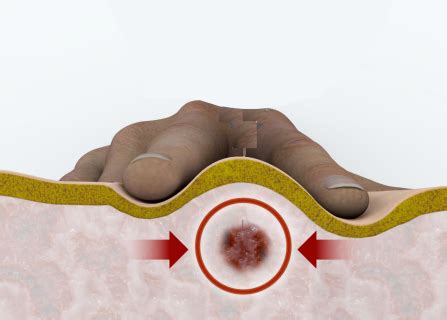 Why Do Trigger Points Keep Coming Back Why Do Trigger Points Keep Coming Back