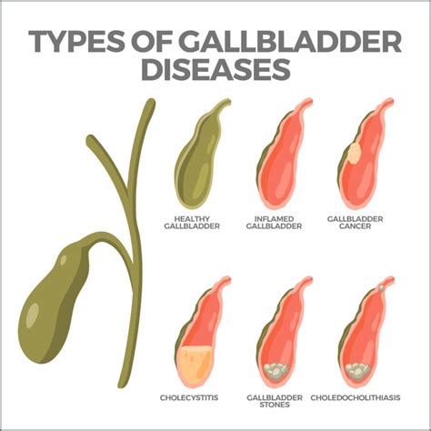 Gallbladder Disease And Treatment Gastro Md