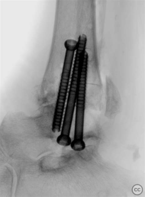 Failed Pronation External Rotation Per Ankle Fracture Dislocation