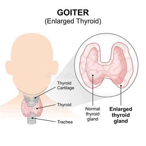 Enlarged Thyroid Gland Goiter Stock Illustrations 279 Enlarged
