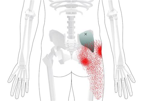 Gluteus Medius Trigger Points Overview Self Treatment Tips