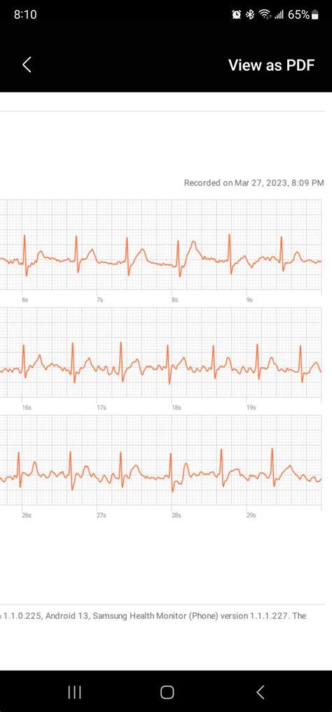 Weird Ecg Readings R Pvcs