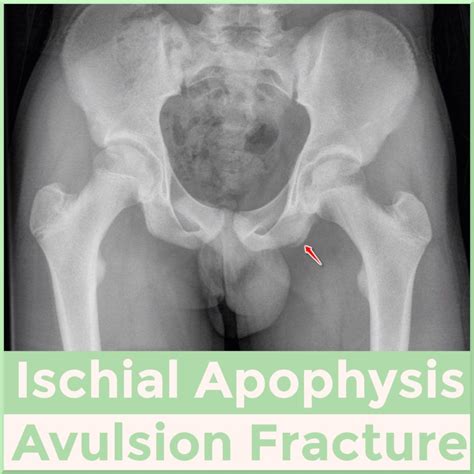 Ischial Apophysis Avulsion Fracture Sports Medicine Review